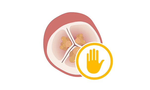 Endocarditis Masterclass: prophylactic antibiotic treatment | Medmastery