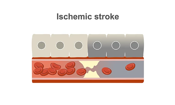 Managing the ischemic stroke patient | Medmastery