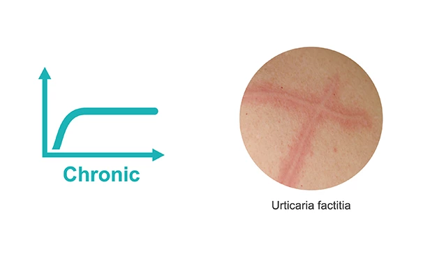 Dermatology 101: diagnosing a transient rash as urticaria | Medmastery