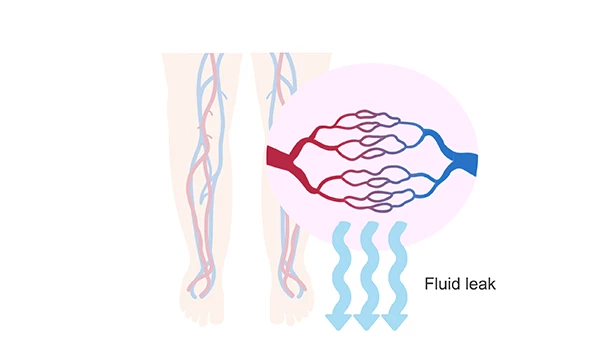 Generating a differential diagnosis for edema | Medmastery