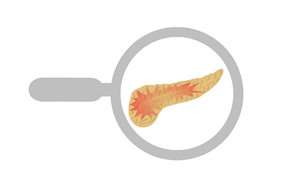 Recognizing acute pancreatitis | Medmastery