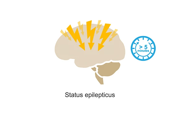 Managing status epilepticus | Medmastery