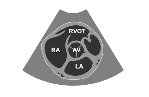 Mastering the parasternal short-axis (PSAX) echo view of the aort ...