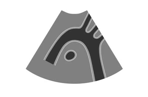 Mastering the suprasternal view of the aorta in echocardiography ...