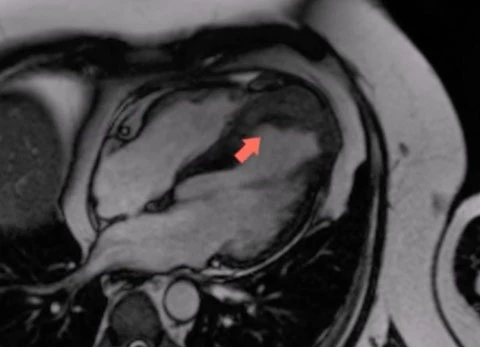 How to assess a left ventricular thrombus with the help of cardia ...