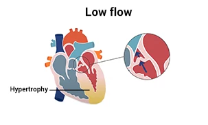 Diagnosing paradoxical low flow | Medmastery