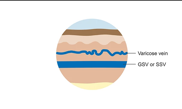 Venous ultrasound course: identifying varicose veins in the insuf ...