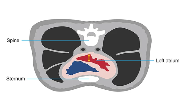 Assessing the left atrium using 3D echocardiography | Medmastery