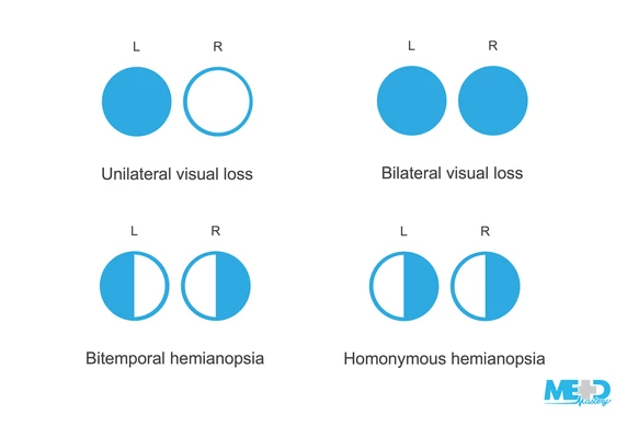 Pituitary Gland Tumor Visual Field Clinically Nonfunctioning Pituitary