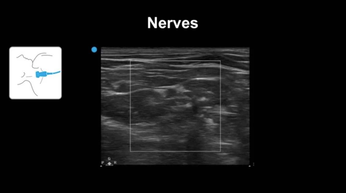 Identifying structures of the neck using ultrasound | Medmastery