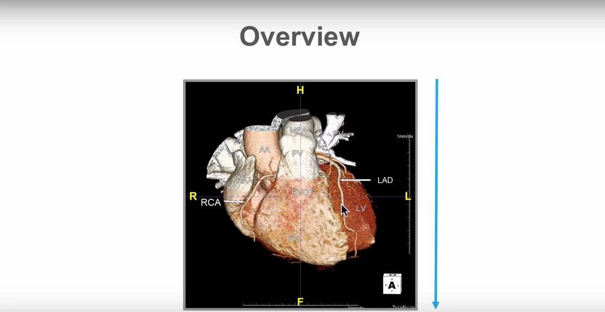 Identify normal heart structures on a cardiac CT scan | Medmastery