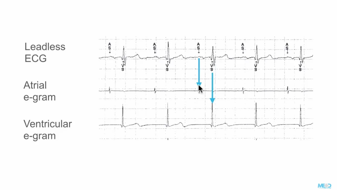Understanding markers and annotations on an ECG | Medmastery