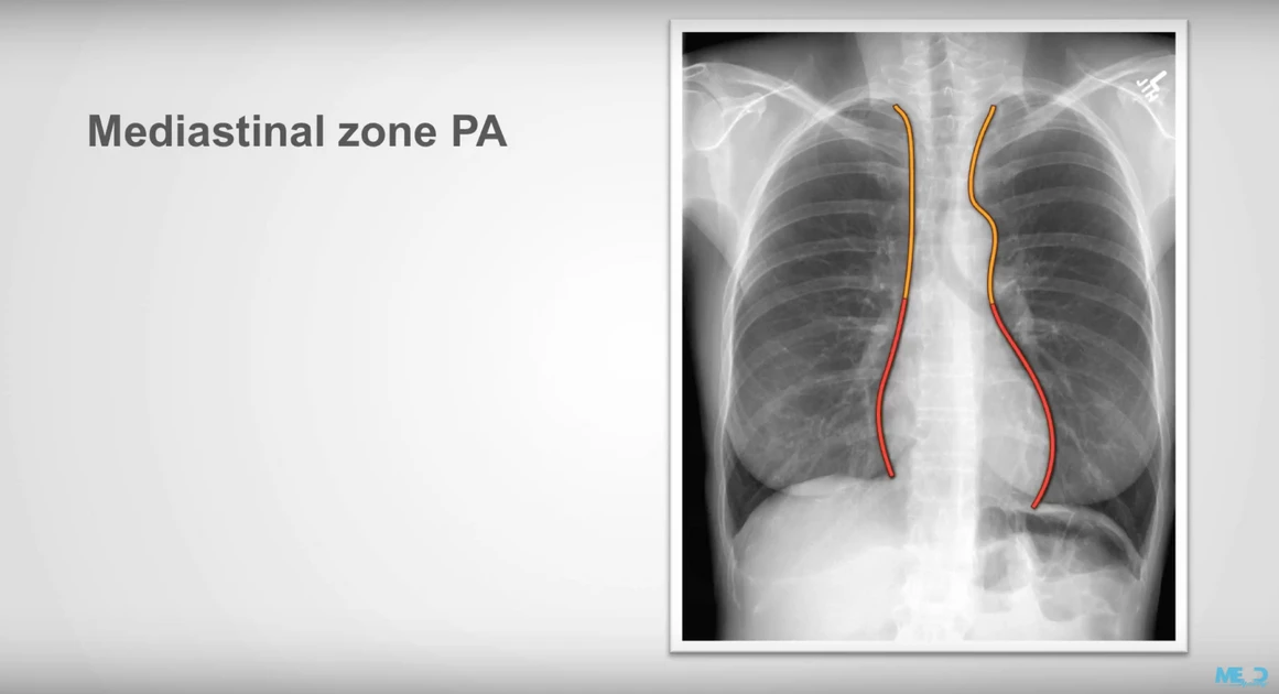 Radiological zones—an introduction to landmarks | Medmastery