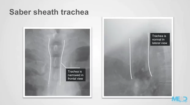 Common pathologies of the trachea and bronchi | Medmastery