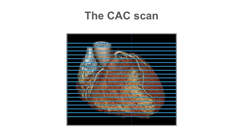 How to score coronary artery calcium (CAC) using cardiac CT | Medmastery