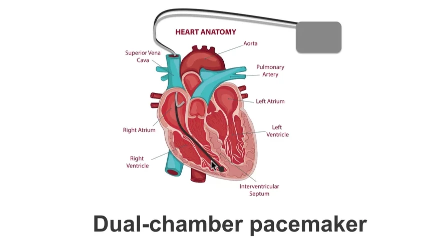 Pacemakers and cardioinhibitory syncope | Medmastery