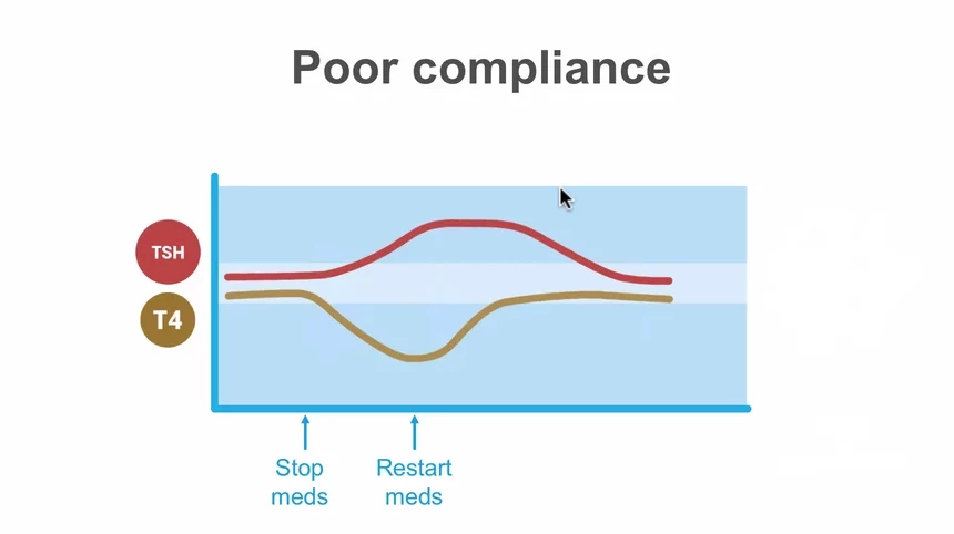 How to identify subclinical hypothyroidism | Medmastery