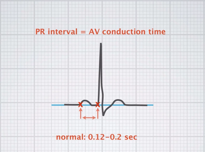 Interpreting ECG duration | Medmastery