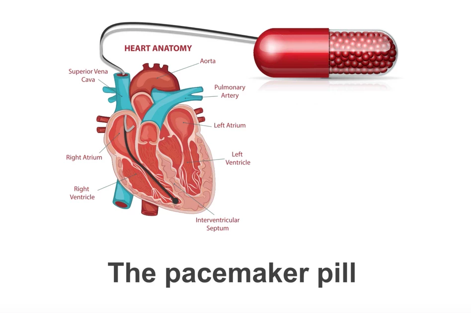 Pacemakers—determining the right amount of pacing | Medmastery