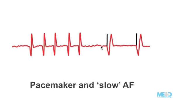 Pacemakers and 'slow' AF patients. | Medmastery