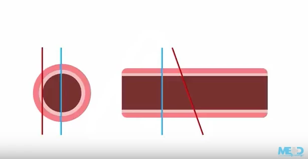 Estimating pulmonary artery systolic pressure (PASP) | Medmastery