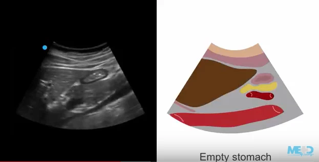 Assessing the stomach for NPO status | Medmastery