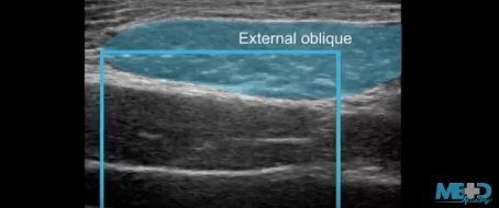 Performing an ultrasound-guided transversus abdominis plane (TAP ...