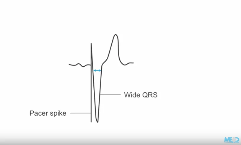 Mastering transcutaneous pacing | Medmastery