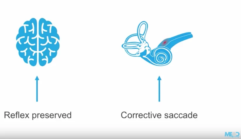 Vertigo maneuvers—performing the HINTS exam | Medmastery