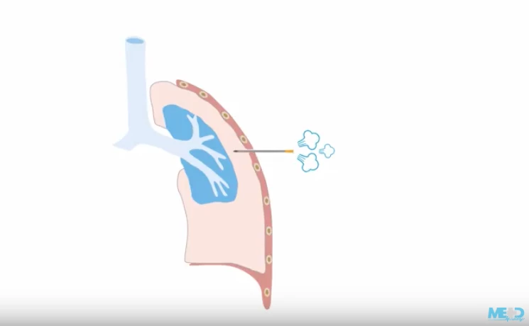 Decompressing a tension pneumothorax | Medmastery