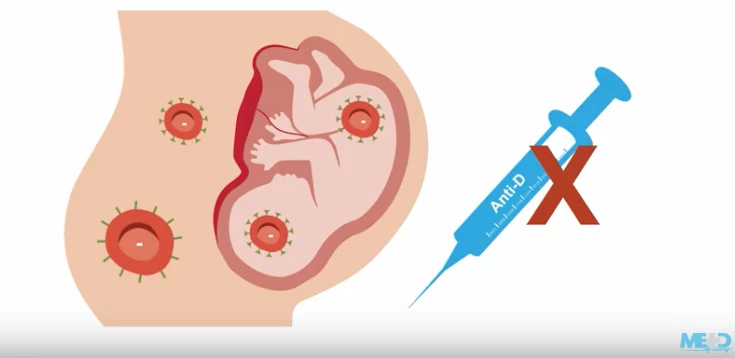 Preventing Rhesus factor disease | Medmastery