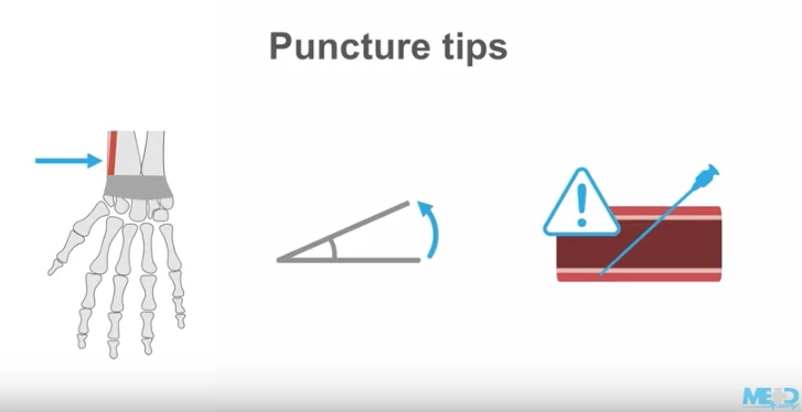 PCI—accessing the radial artery | Medmastery