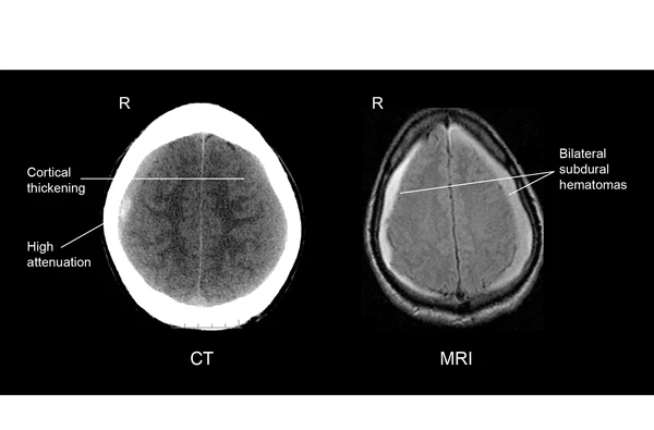 Epidural Hematoma Vs Subdural Hematoma Vs Subarachnoid Hemorrhage