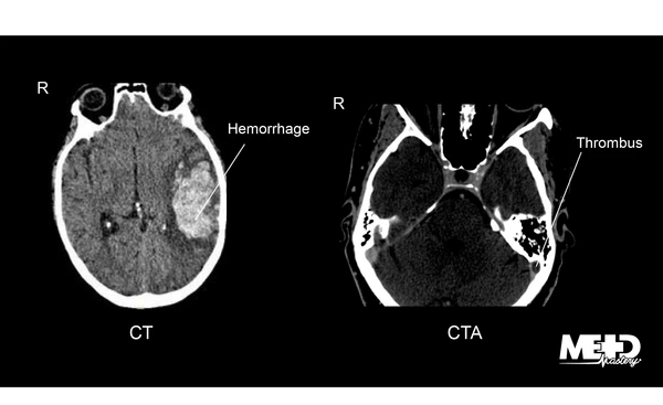 Brain Hemorrhage Scan