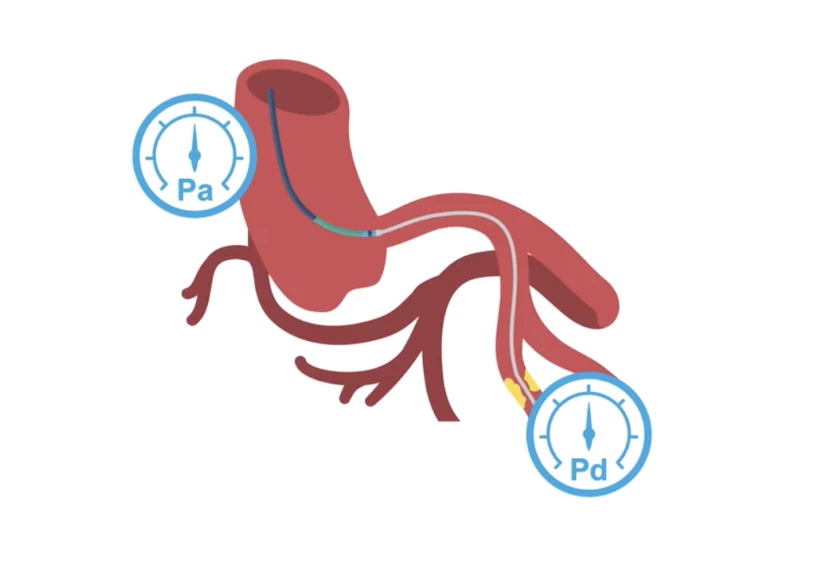 PCI—using a pressure wire to determine the significance of a st ...