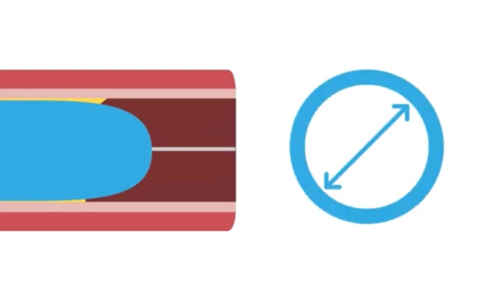 PCI—loading a balloon and pre-dilatation | Medmastery