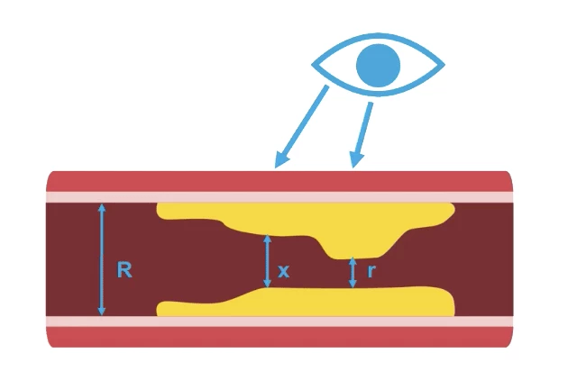 PCI—identifying lesion severity | Medmastery