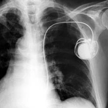 Common pacemaker problems (part 1): Failure to capture | Medmastery