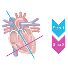 Ask Andrew: Determining the origin of ventricular ectopic beats o ...